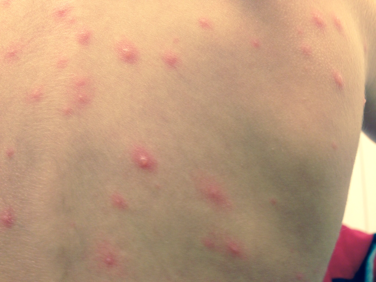 Varicela. Pelos pediatras Emídio Carreiro e Paulo Coutinho – Paulo Coutinho